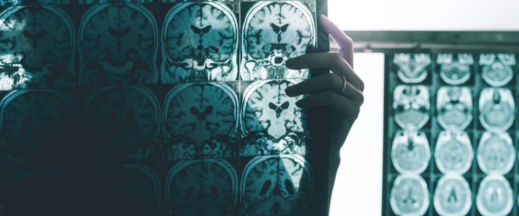 Entenda a Malformação de Chiari e seus sintomas | Dr. Thiago Rodrigues